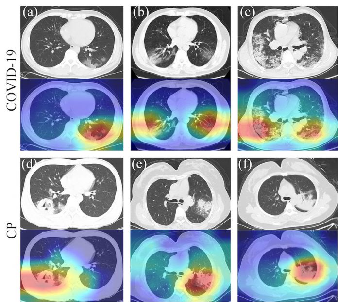 Automatic Pneumonia Diagnosis Developed By Um Science And Technology